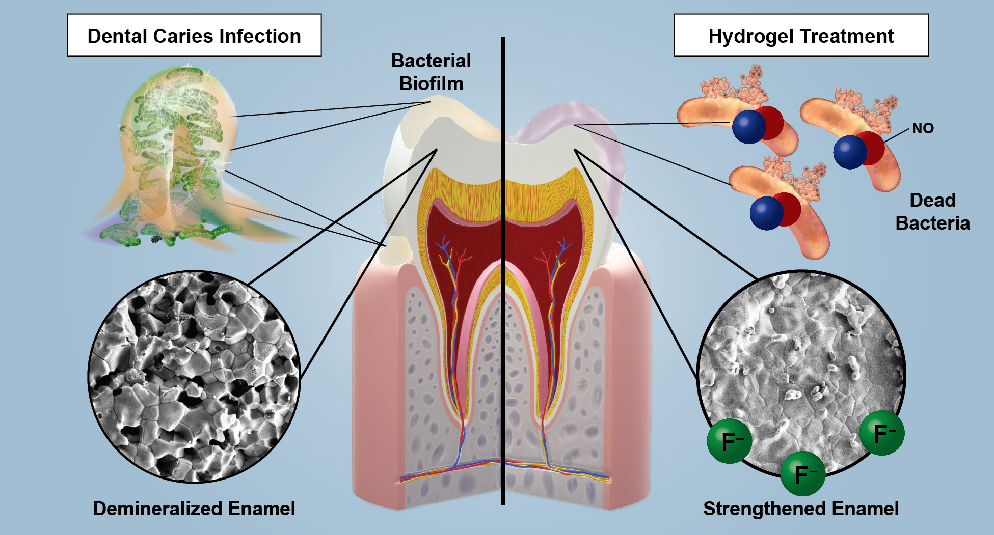 Dental Caries Treatment